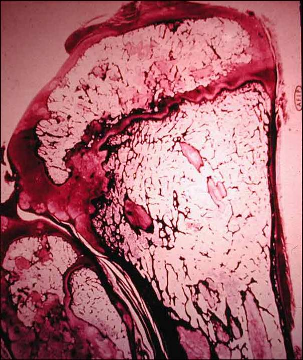 Enchondromas - Pathology - Orthobullets